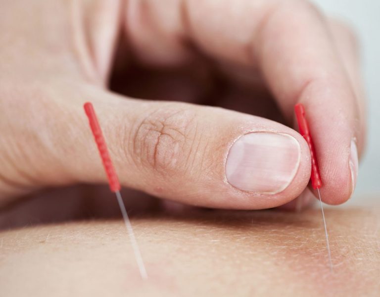 Apakah Terapi Akupunktur Bisa Mengatasi Saraf Kejepit? - Aruna Baby Spa ...